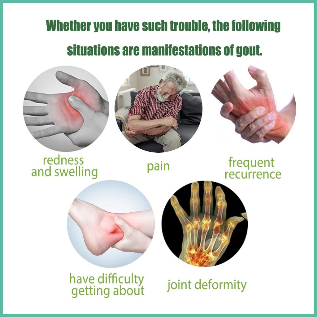 Goutto Japan Medicine 10 Pcs/Box Gout Paste Big Toe Joint Gout Lowering ...