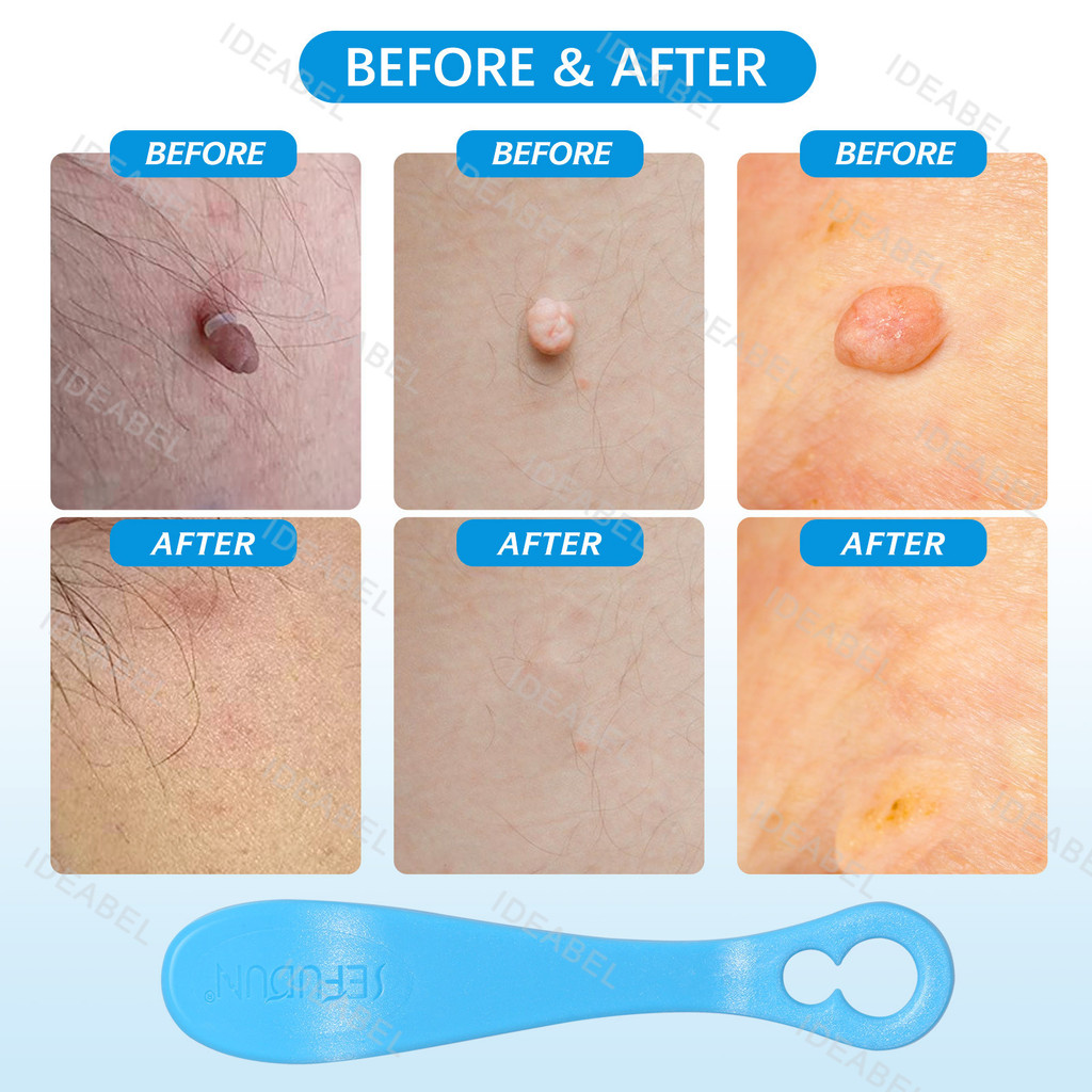 Facial Mole Wart Microstrip Tag Skin Tag Removal Mole Wart Removal ...