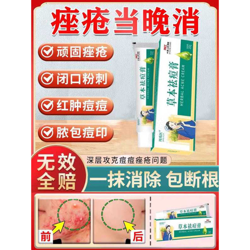 Acne, Severe Cream For Pimples, Rosacea, Closed Comedones, And Facial ...