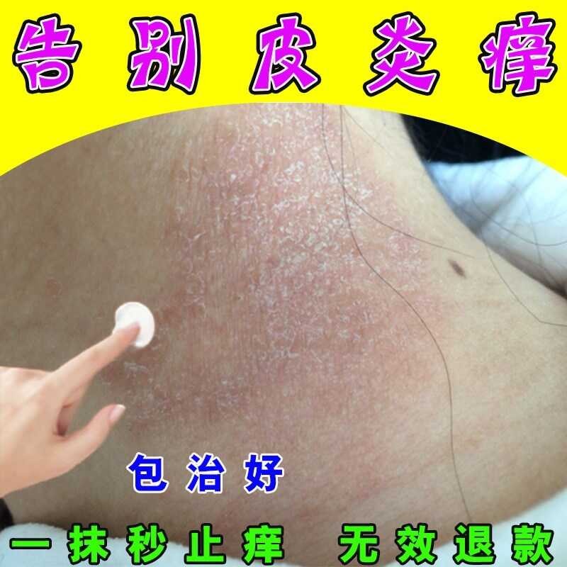Topical Non-Hormonal Neurodermatitis Stubborn Neck Redness Itching ...