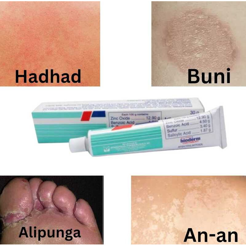 870 Anti-Fungal Ointment: Panlaban Sa Alipunga, Buni, Hadhad, An-An At ...