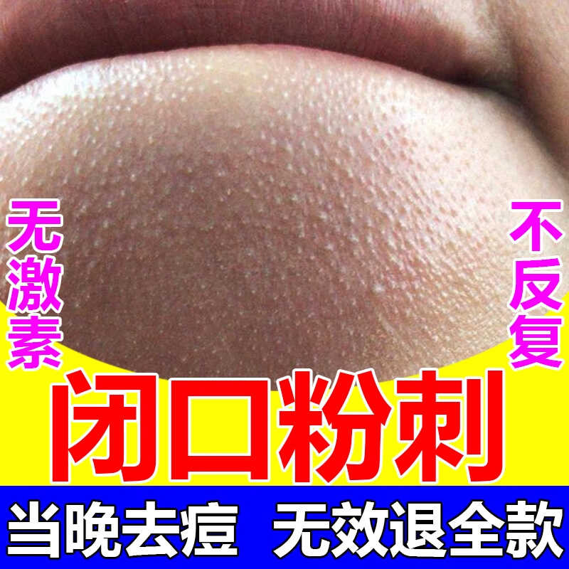 Forehead Face Chin Facial Long Closed Comedone Killer Remove Pimples ...