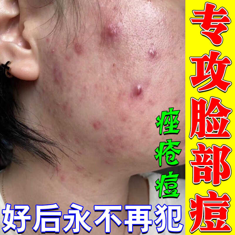 For Cream Severe Acne, Closed Comedones, And Pimples, Chin Lymph Node ...