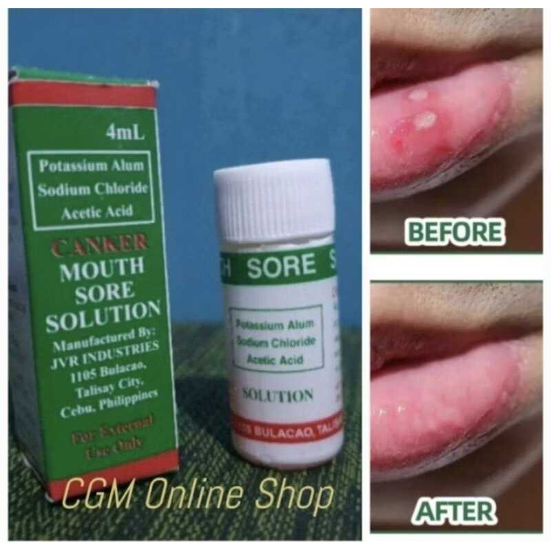 CANKER MOUTH SORE SOLUTION (Gamot Sa Singaw) 3 | Shopee Philippines