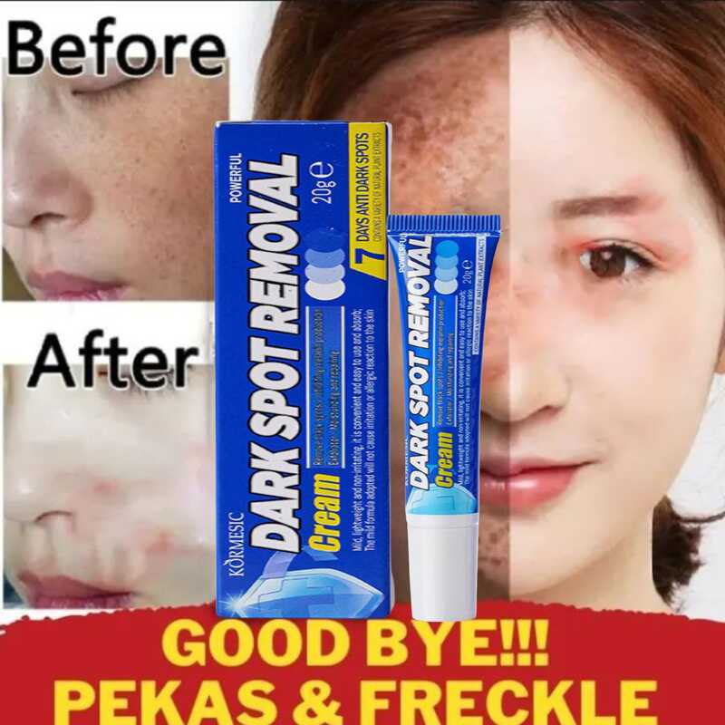 ORIGINAL Melasma Pekas Remover Whitening Glass Skin Anti Freckles Cream ...