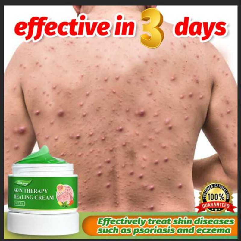 Gamot Sa Kati Balat Ointments For Skin Deases Eczema Treatment Anti ...