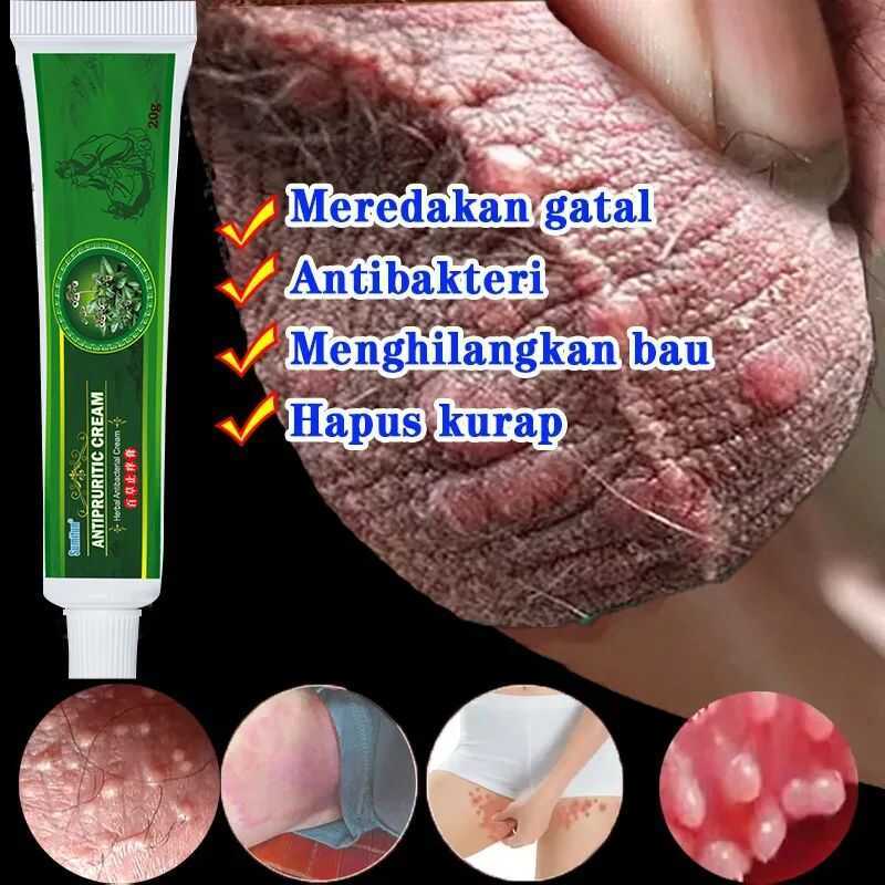 Gamot Kati Sa Balat Ointment Eczema Treatment Original Fungisol ...