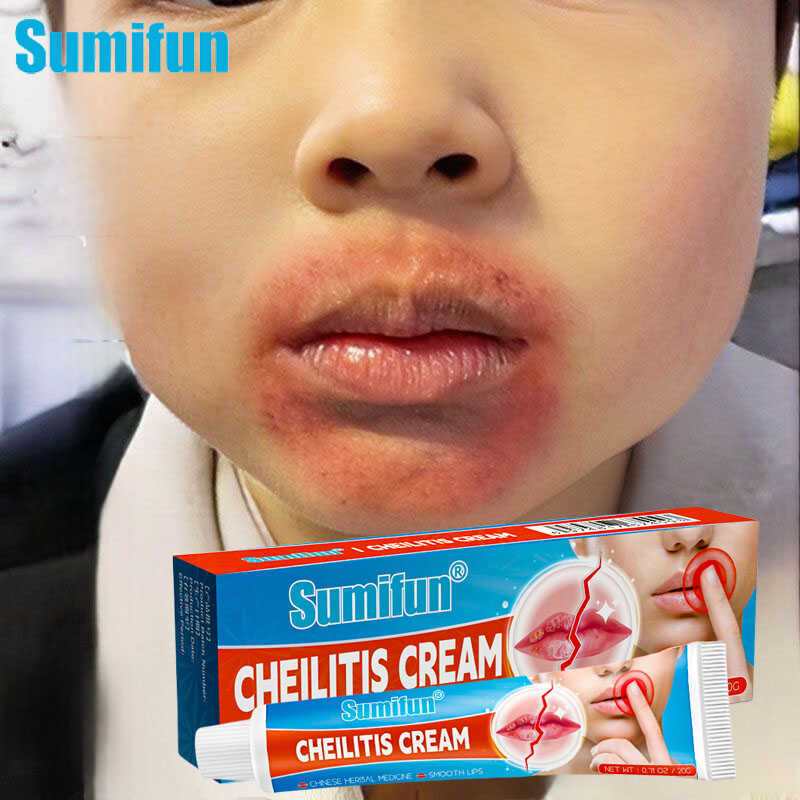 Cold Sores Lip Cheilitis Treatments Cream Herpes Antibacterials ...