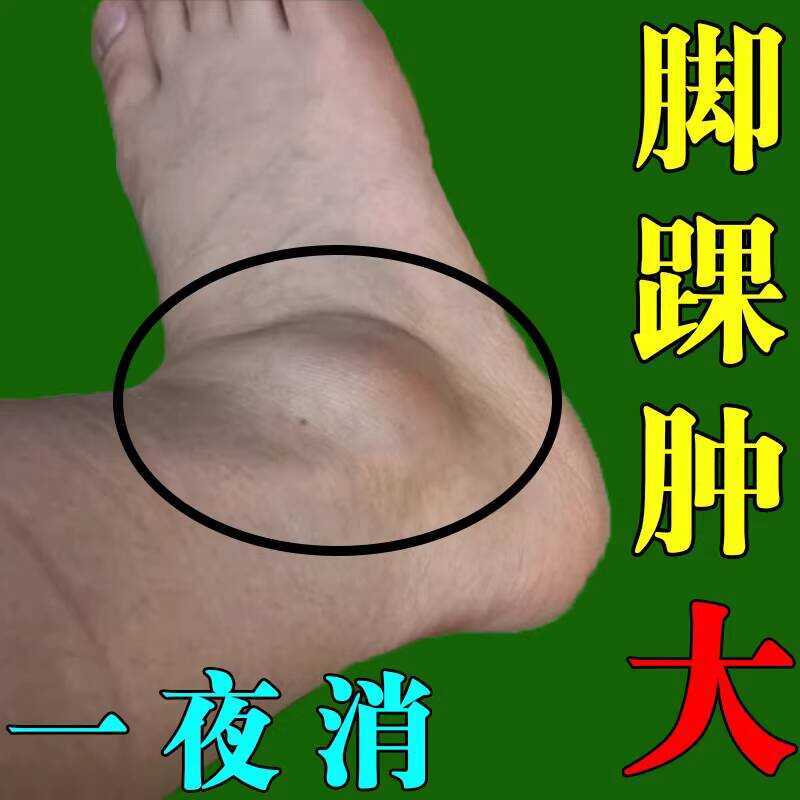 Swollen Ankle Painful Muscle Pain Sprained Foot Torn Bruised Tendon ...
