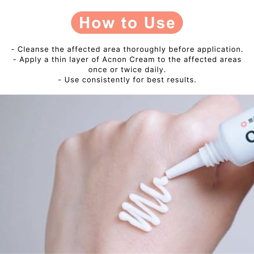 Acnon Cream Aclean Gel Acne Treatment Red acne, Pimples, Pustular acne ...