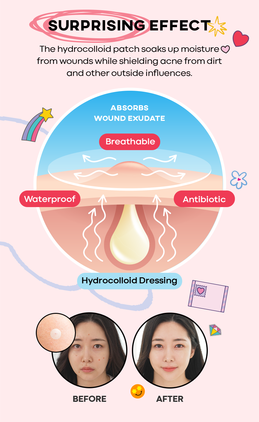 NOLAHOUR Pimple Clear Spot Patch 26 Patches(Treatment, Protects ...