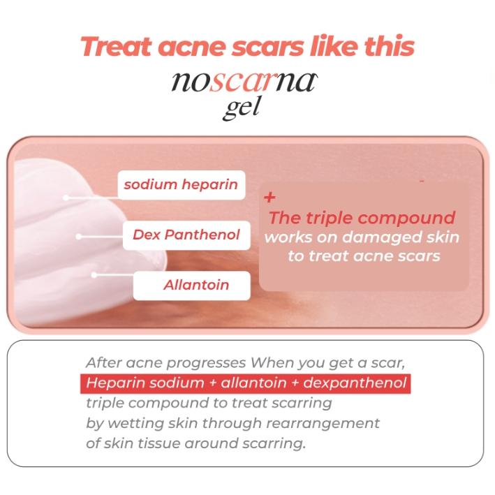 NOSCARNA Gel 10g/20g for Acne Blemish Scars Removal, Clear Marks ...