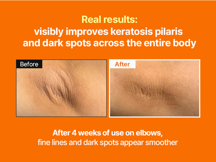 [MEDITHERAPY] Retinal Skin booster Serum 150ml/ Brightening & Acne ...