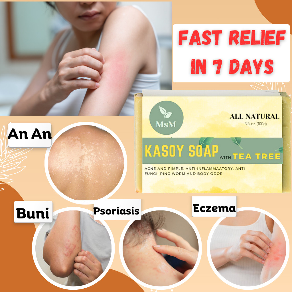An An Remover Kasoy Soap: Skin Disease Treatment for Itchy, Buni ...