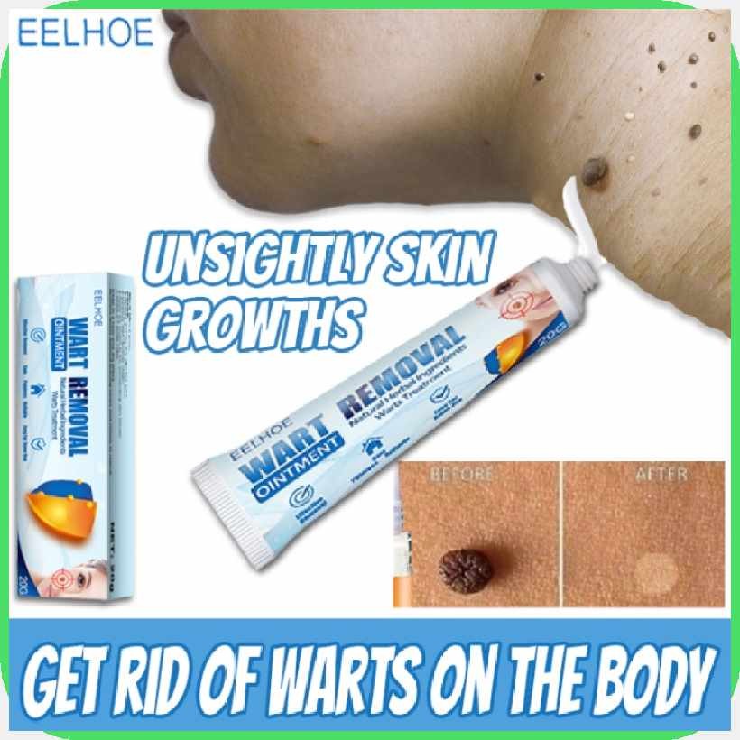 EELHOE Warts Remover Original Cream Face Wart Treatment Ointment Body ...
