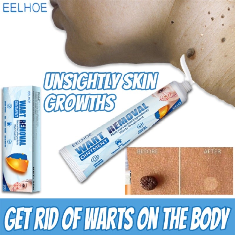 EELHOE Warts Remover Original Cream Face Wart Treatment Ointment Body ...