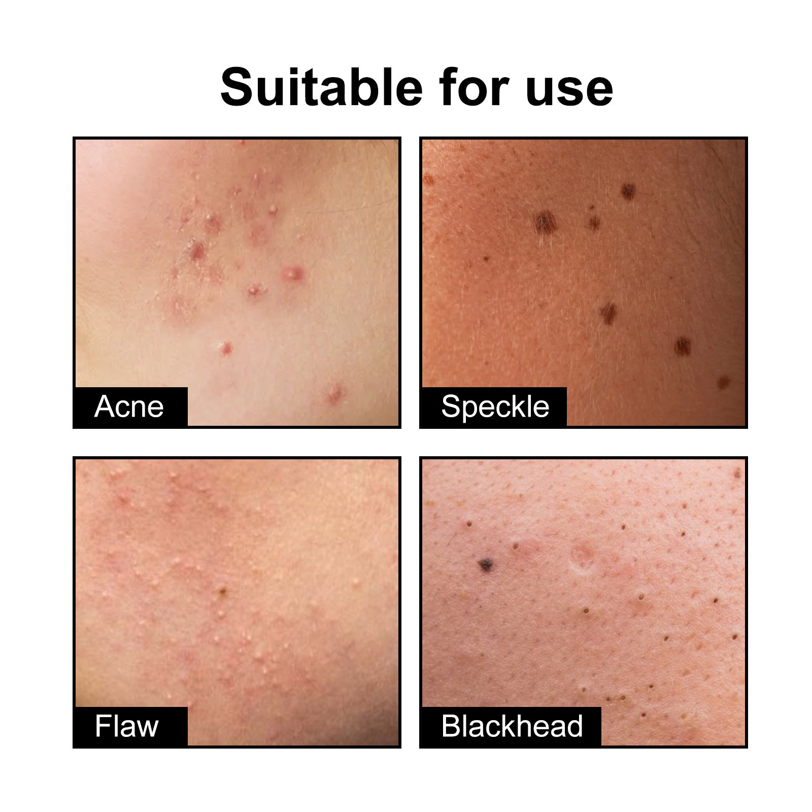 New Hydrocolloid Acne Patches for pimples, blackheads, and blemishes ...