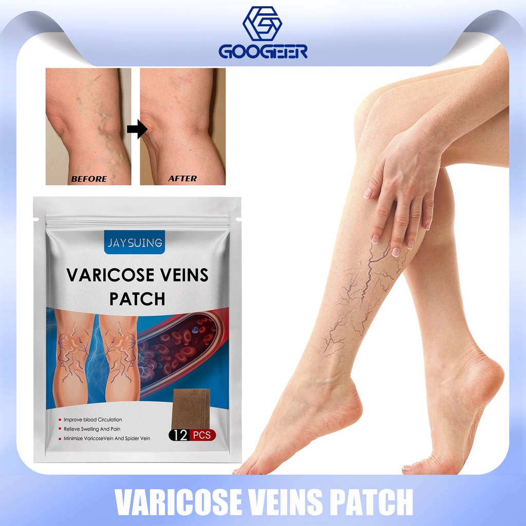 Jaysuing Varicose Veins Patch Intravenous Remover Patch Varicose Vein ...