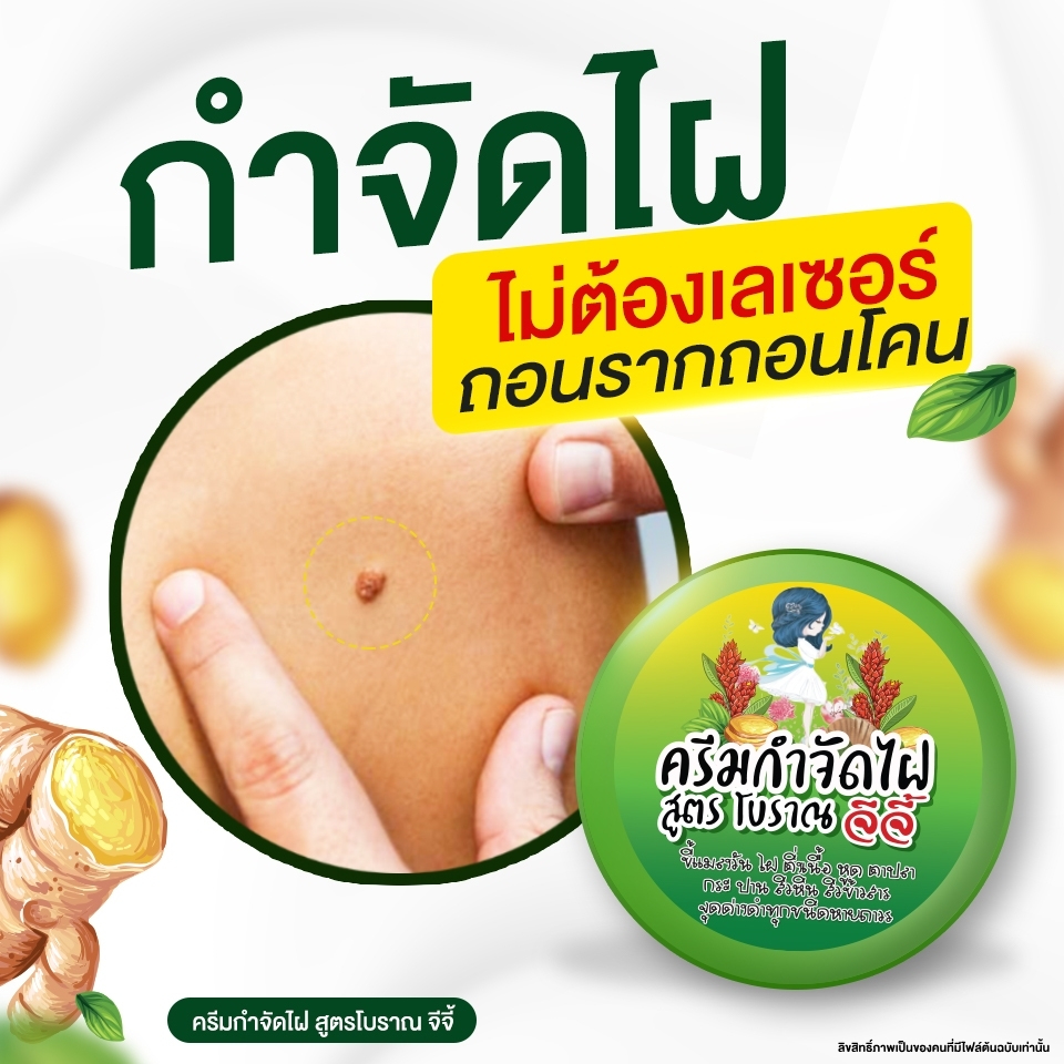 Gigi Mole Cream Flies Polyps Wart Corn Eyes Solve The Problem Of ...