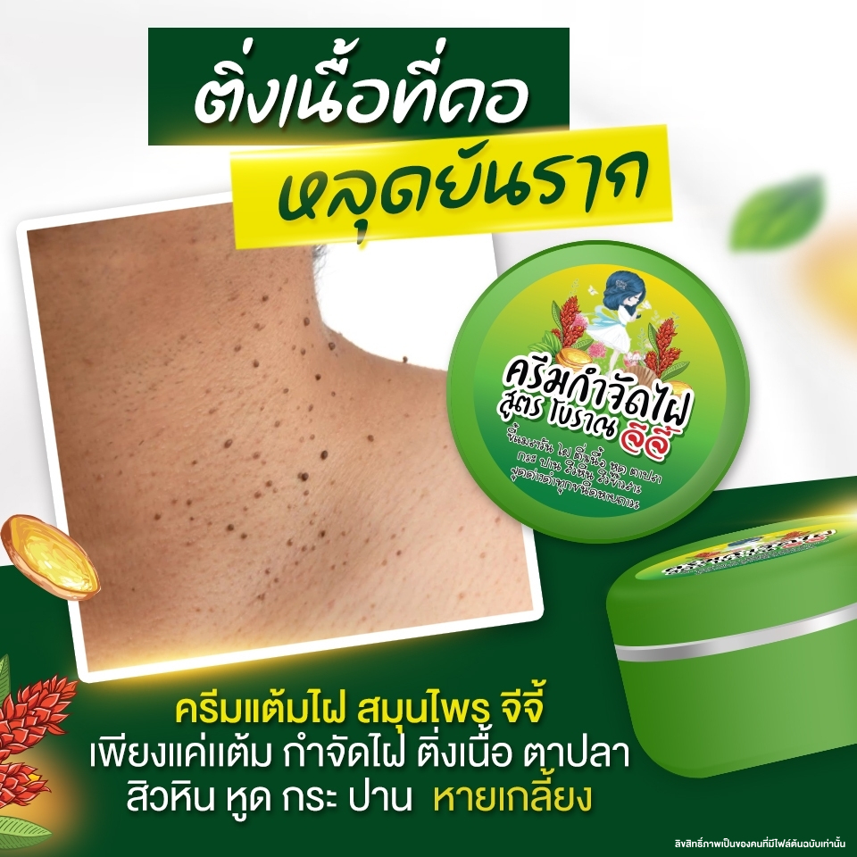 Cream Mole Jely Flies Polyps Wart Corn Eyes Solve The Problem Of ...