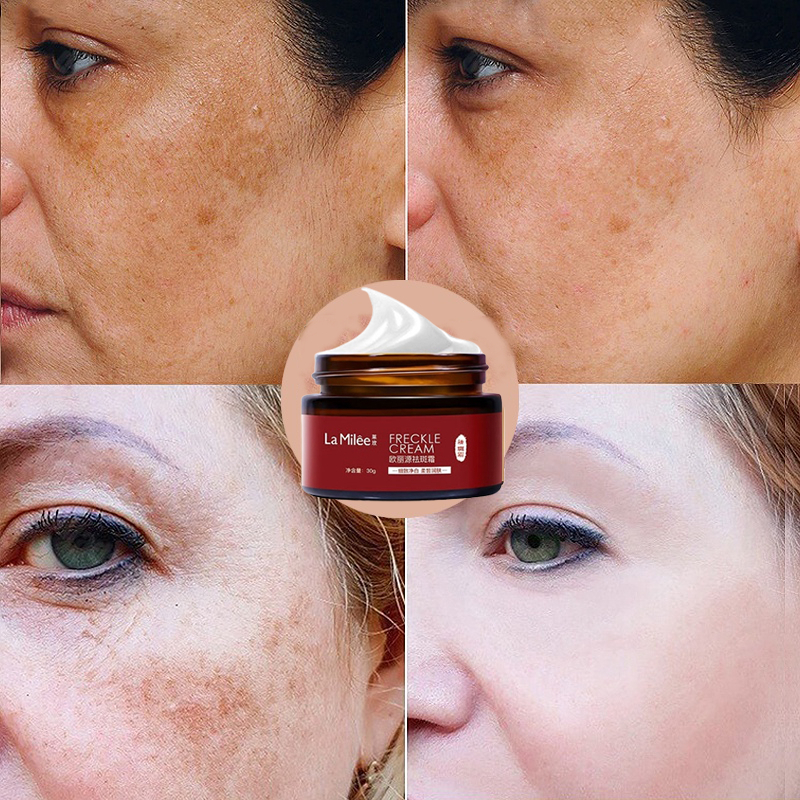 Freckle removal cream 30g Slingshotm removal cream skin whitening ...