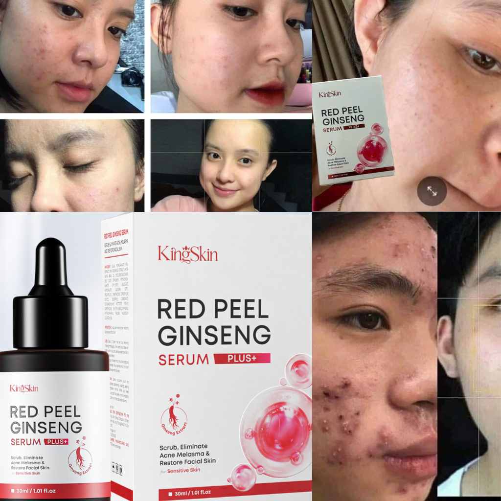 Peel Serum Peel Skin, Remove Hidden Acne, Blackhead, Red Head, Scar ...